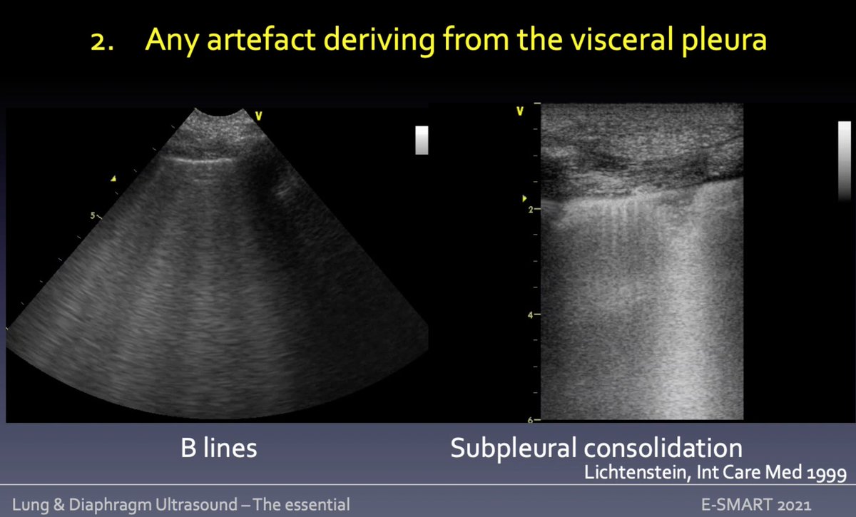 Essential of lung/diaphragm #POCUS tutorial 🧵 🦇 sign identify lung in ...
