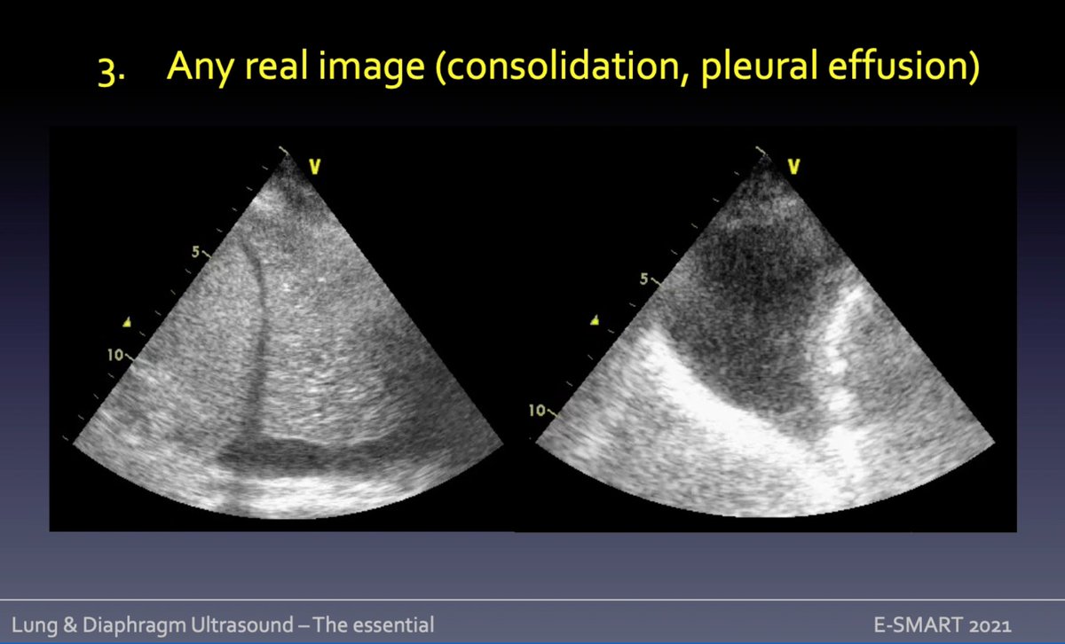 Essential of lung/diaphragm #POCUS tutorial 🧵 🦇 sign identify lung in ...