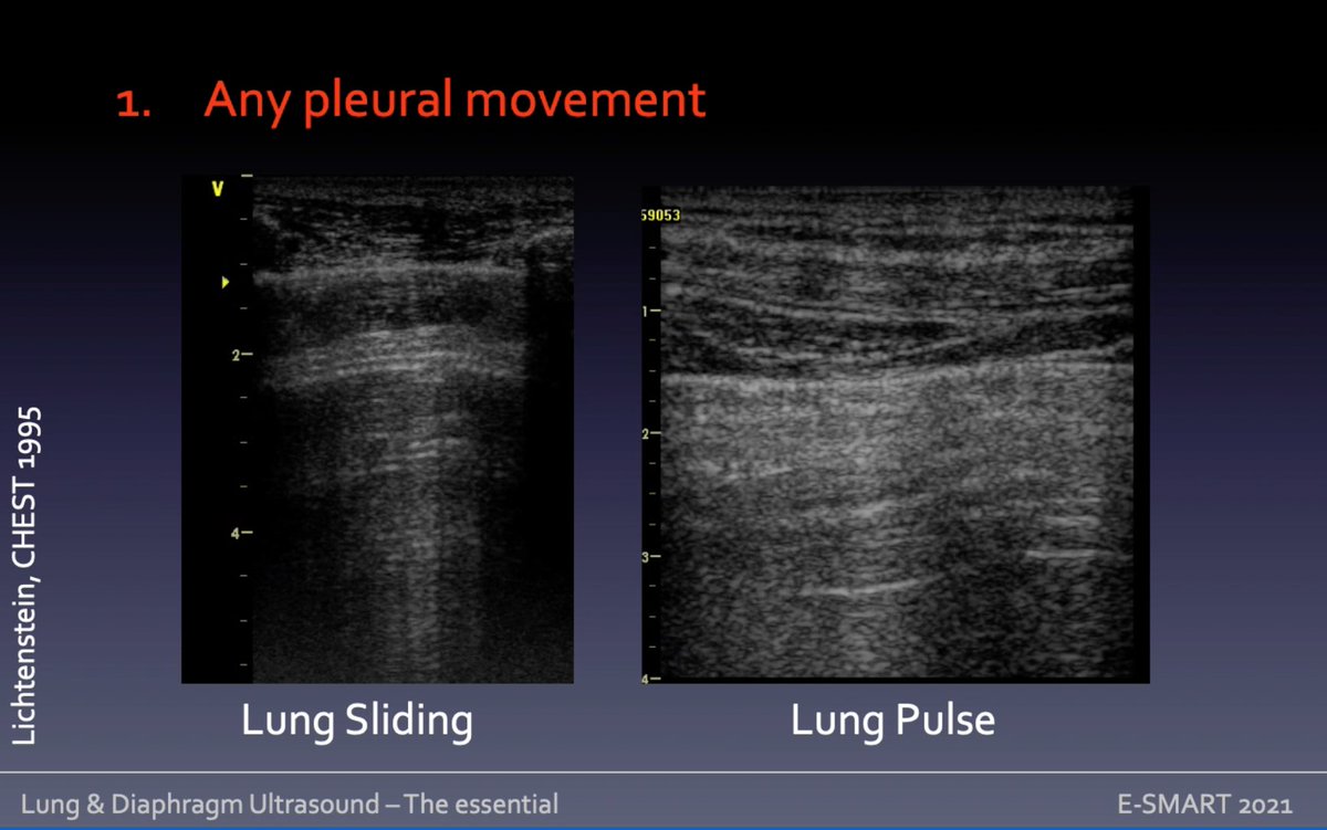 Essential of lung/diaphragm #POCUS tutorial 🧵 🦇 sign identify lung in ...