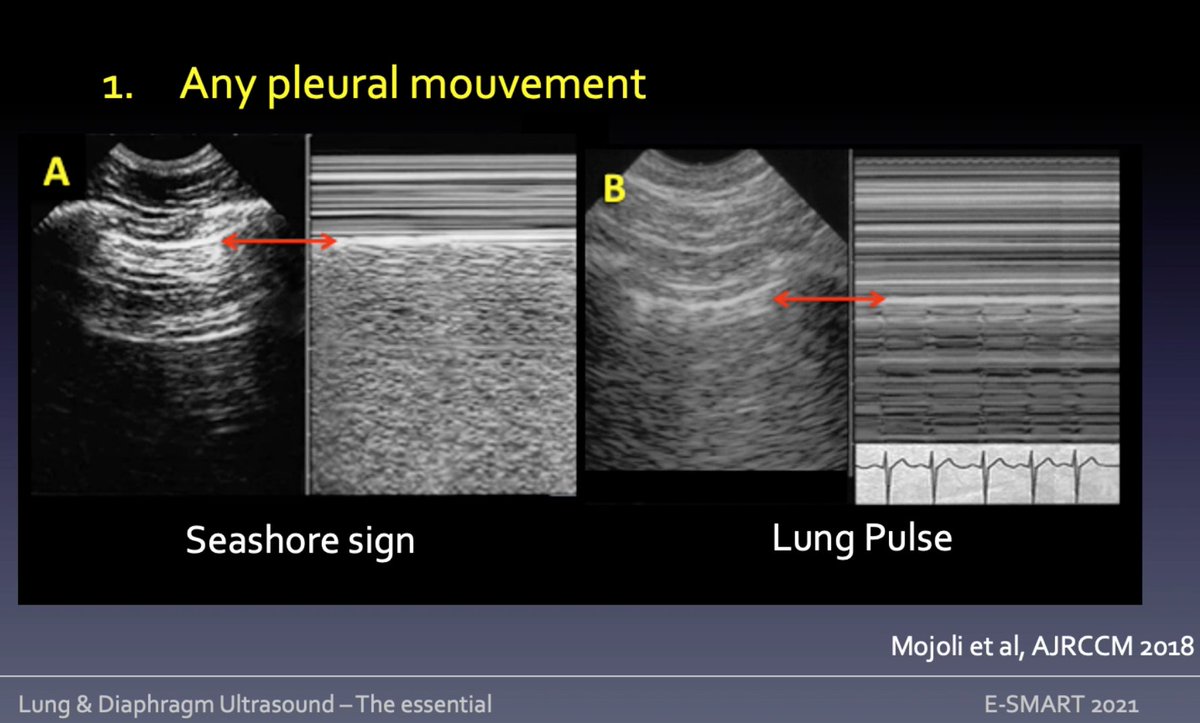 Essential of lung/diaphragm #POCUS tutorial 🧵 🦇 sign identify lung in ...
