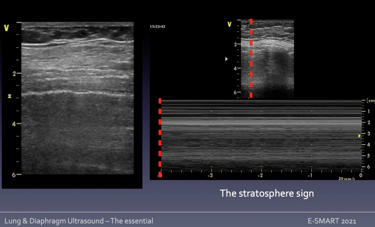Essential of lung/diaphragm #POCUS tutorial 🧵 🦇 sign identify lung in ...
