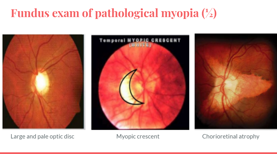 Choroidal Crescent Optic Nerve