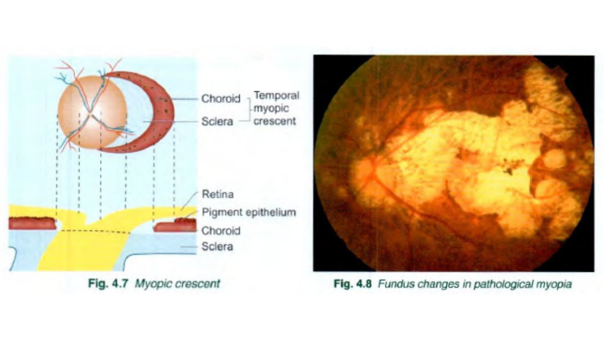 Pigmented Scleral And Crescents