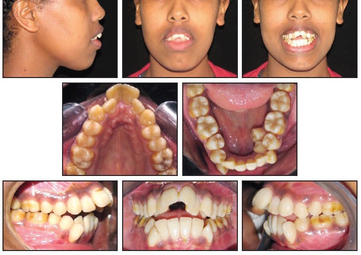 Gigi Jongang Pakai Braces Elisabethmcybarron