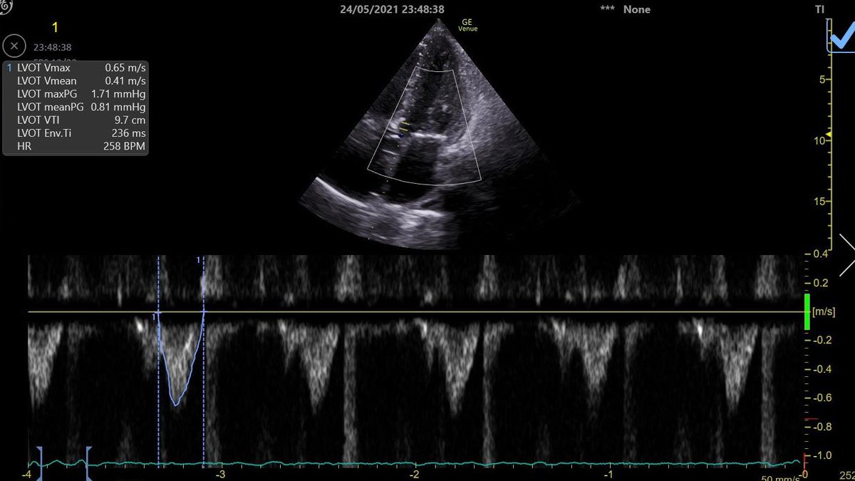 #POCUS in Hemodialysis 👵 w 🫀 failure and ESRD ️ 🏥 for peritonitis. PD ...