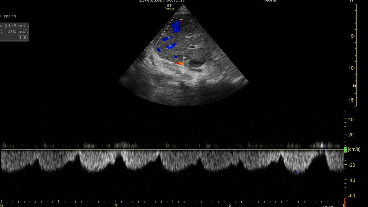 #POCUS in Hemodialysis 👵 w 🫀 failure and ESRD ️ 🏥 for peritonitis. PD ...