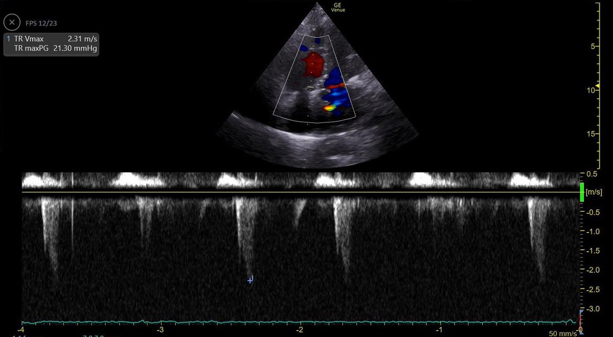#POCUS in Hemodialysis 👵 w 🫀 failure and ESRD ️ 🏥 for peritonitis. PD ...