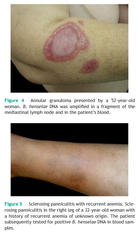 Bacillary Angiomatosis Bartonella