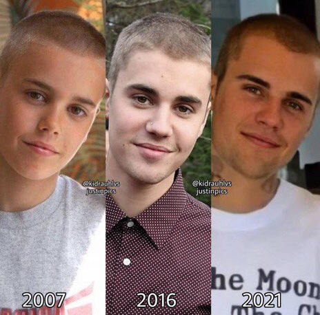 Justin Bieber Bald