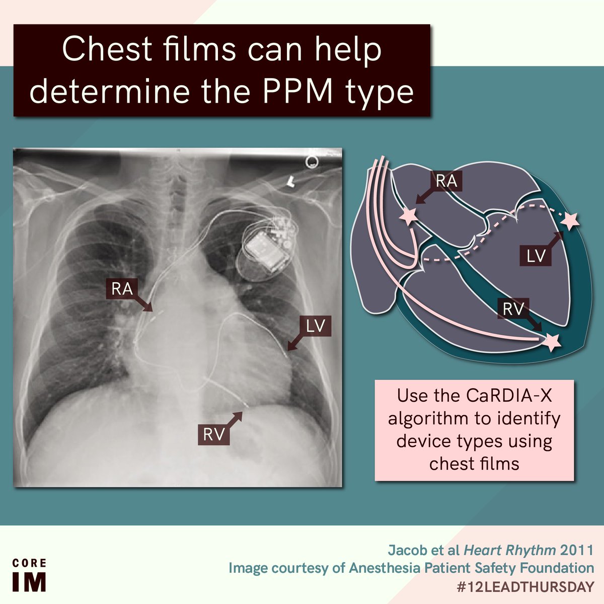 1/ goooooood morning, #MedTwitter, and happy #12LeadThursday-on-a ...