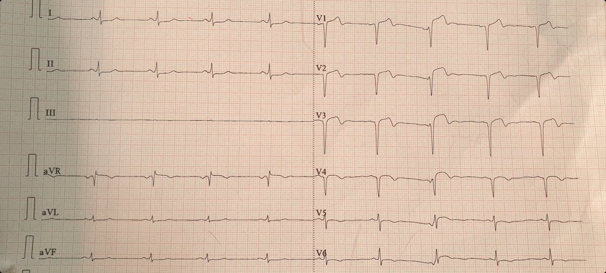 Derrame Pericárdico Ecg