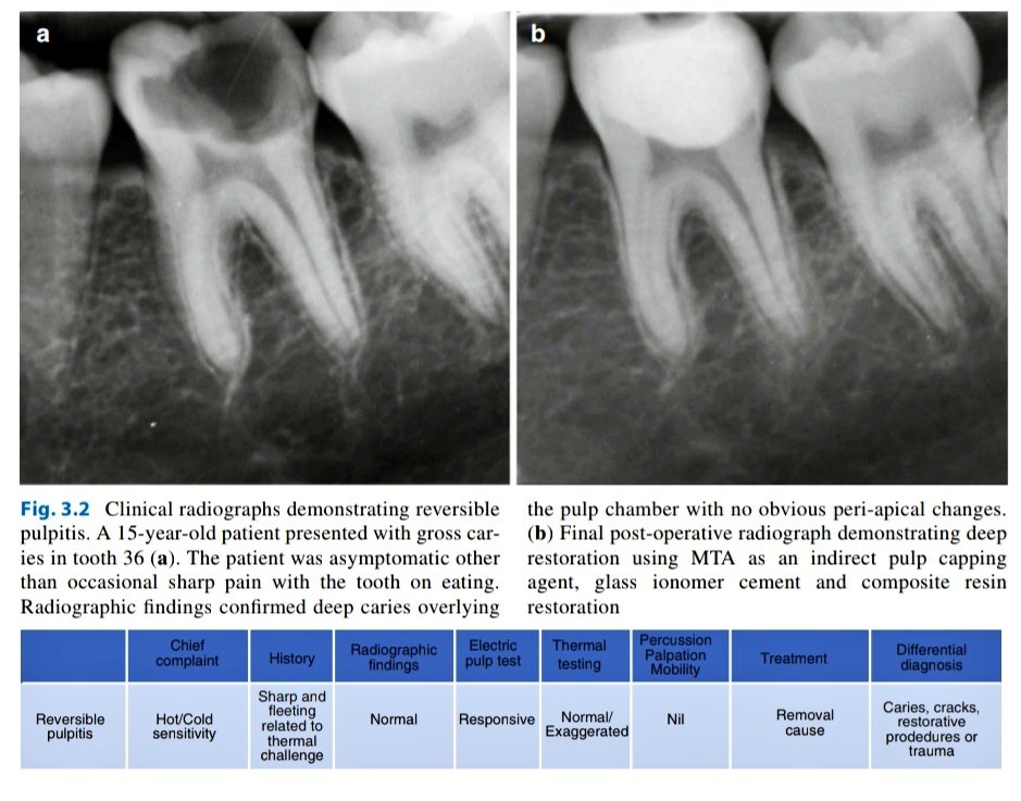Reversible Pulpitis Treatment Outcomes Of Pulpotomy In Primary Teeth