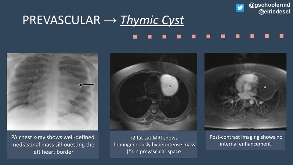 Thymic Cyst