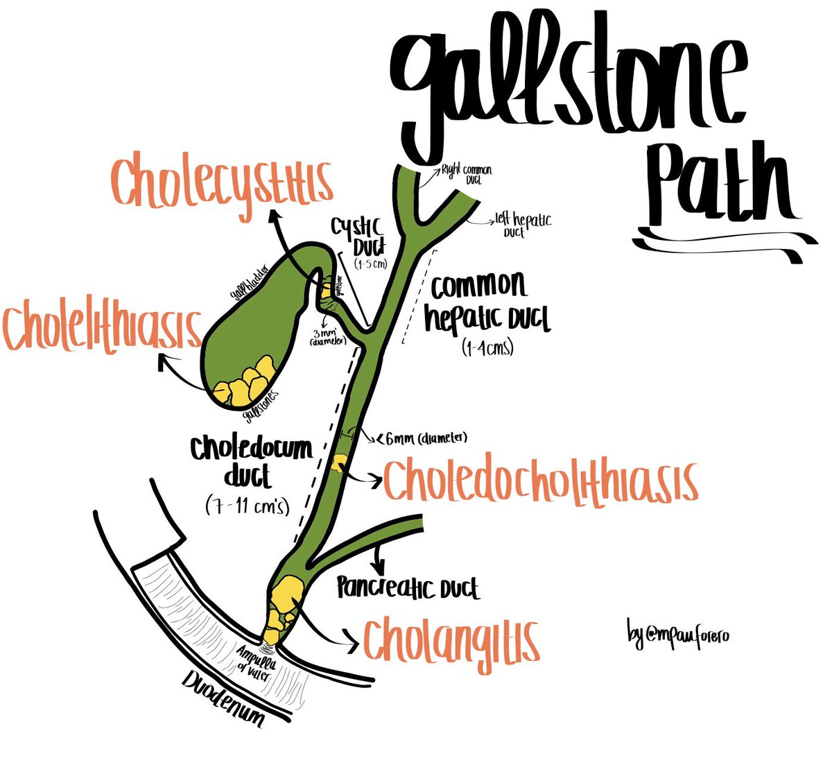 Choledocholithiasis Vs Cholelithiasis