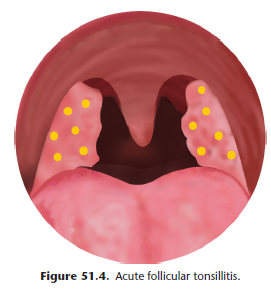 Acute Catarrhal Tonsillitis