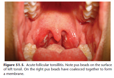 Acute Catarrhal Tonsillitis