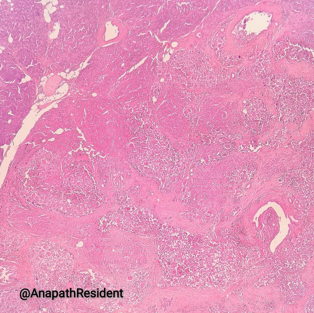 Icd 10 Code For Invasive Squamous Cell Carcinoma Of Larynx
