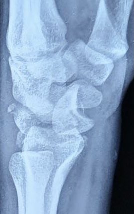 Lunate Dislocation Pie Sign