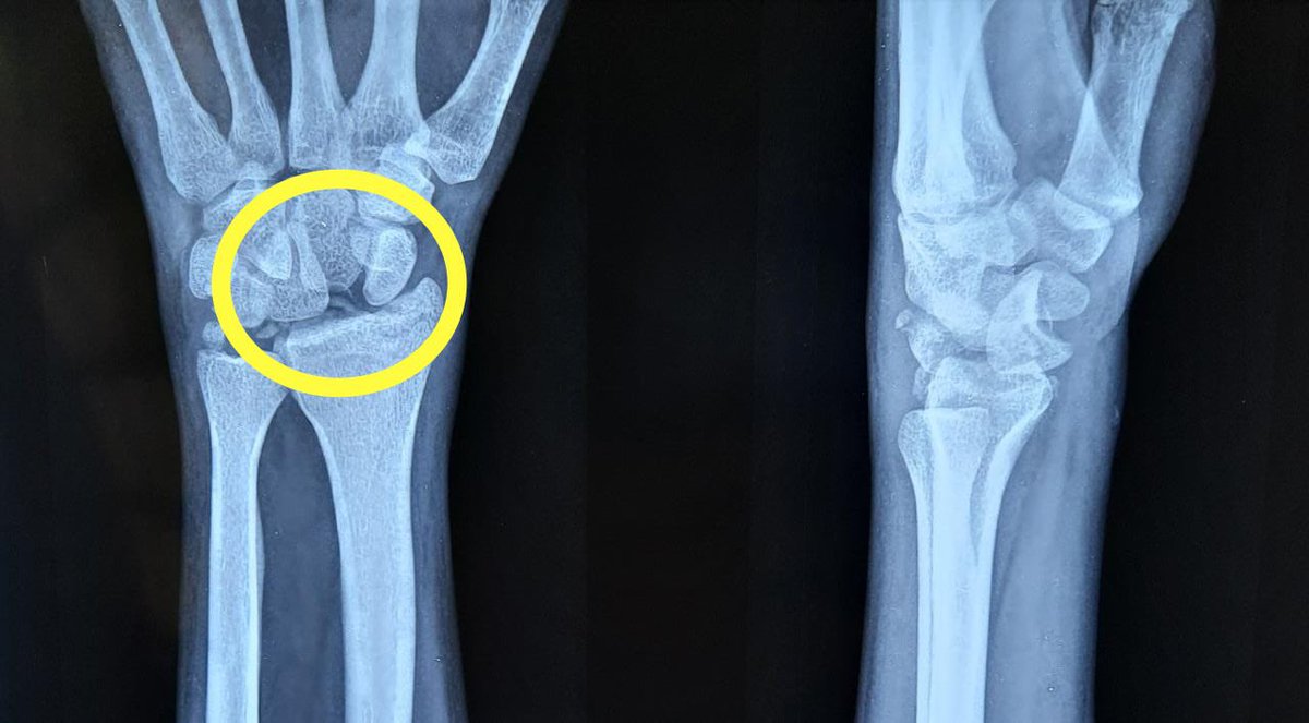 Lunate Dislocation Pie Sign