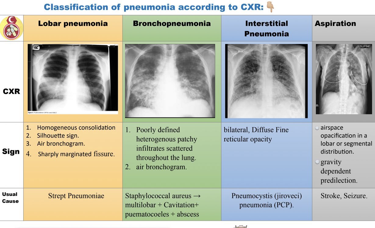 Bronchopneumonia Vs Lobar Pneumonia