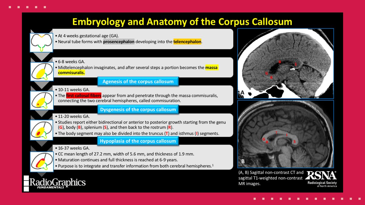 Corpus Callosum Anatomy Genu Rostrum