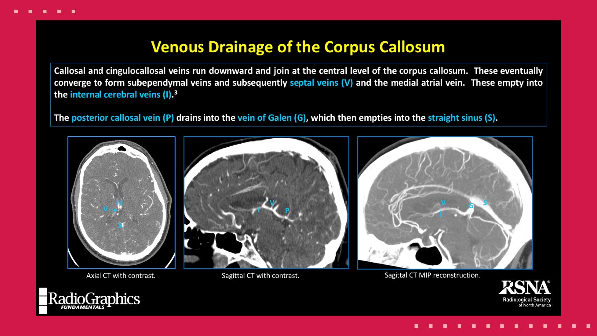 Differential Diagnosis of Corpus Callosum Lesions: Beyond the Typical ...