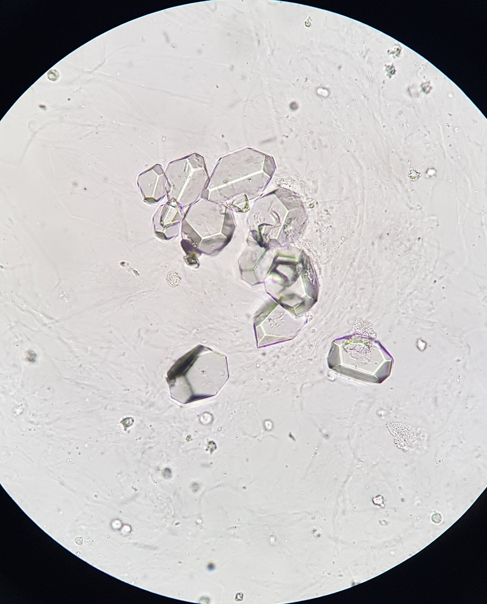 Triple Phosphate Crystals In Urine