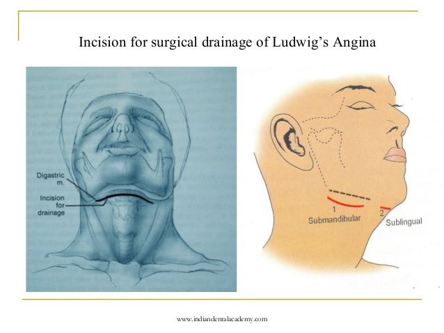 Incision For Ludwigs Angina