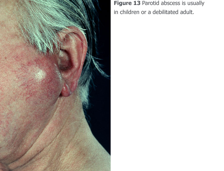 Parotid Abscess