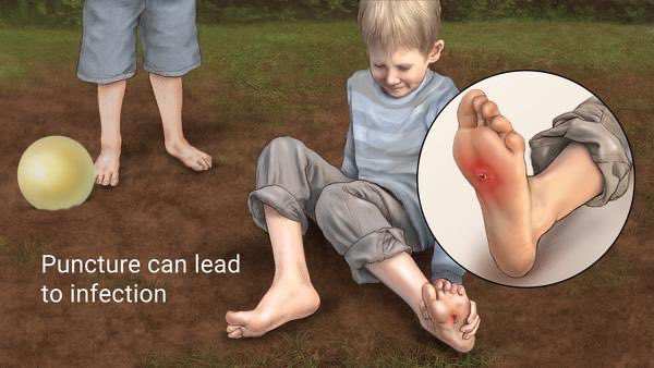 Foot Stepped On Nail Shop | emergencydentistry.com