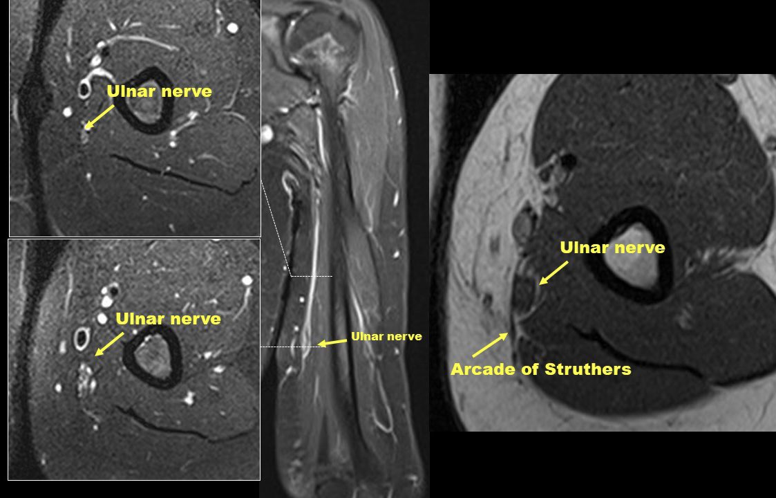 Ulnar Nerve Entrapment Mri