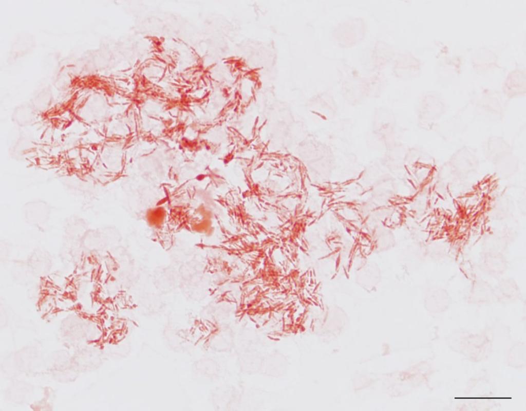 Weekend Digest A boy from Indiana has fevers, chills, and erythematous ...