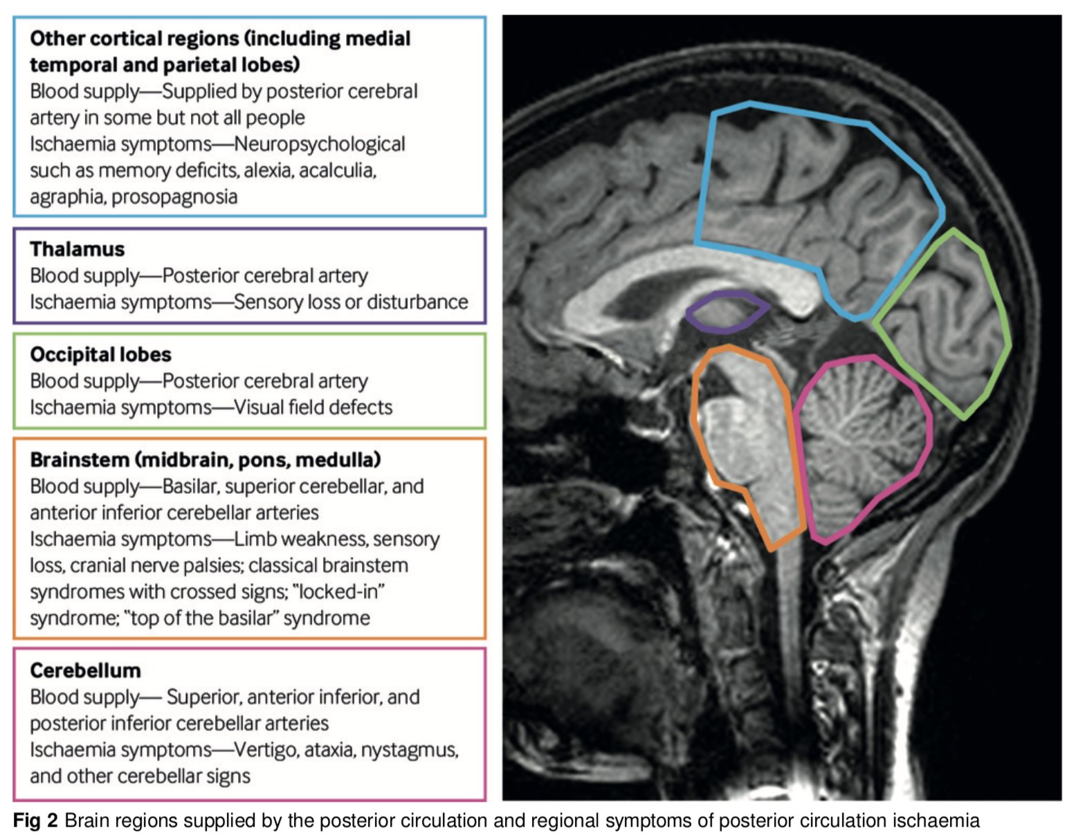 Basilar Artery Pons