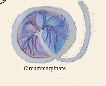 Circummarginate Placenta