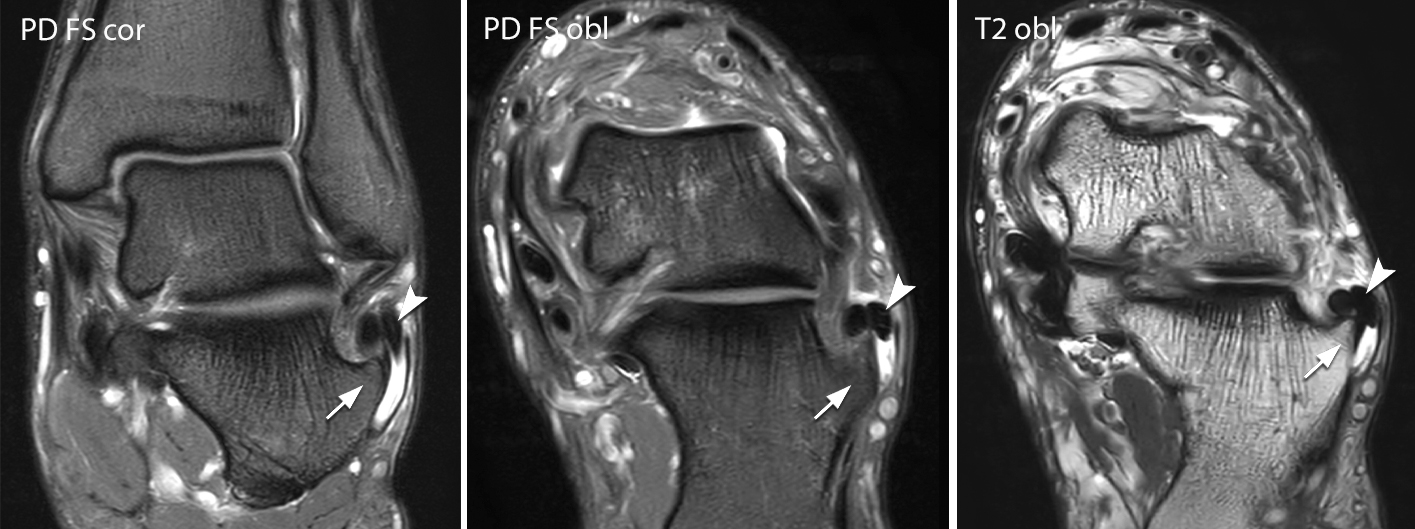 Peroneal Retinaculum Mri