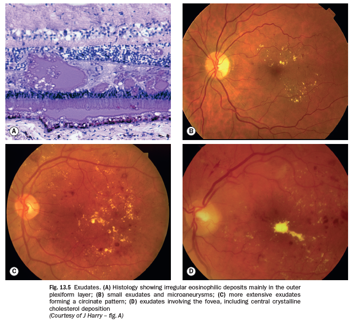 Retinal Flame Hemorrhage
