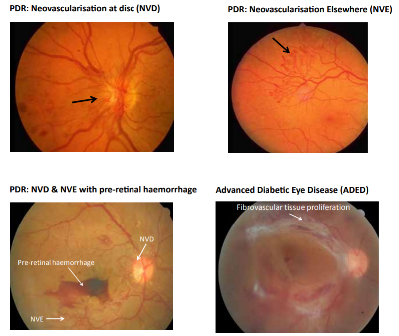 Retinal Hemorrhage Boat