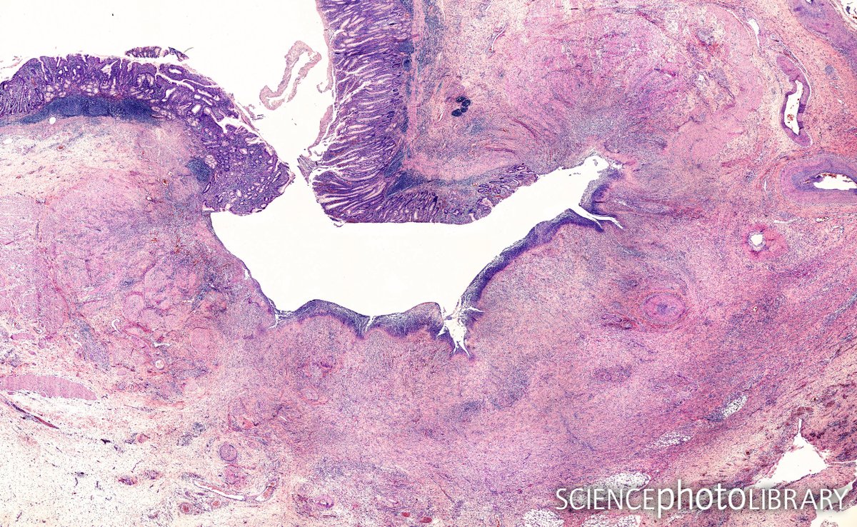 Gastric Ulcer Histology