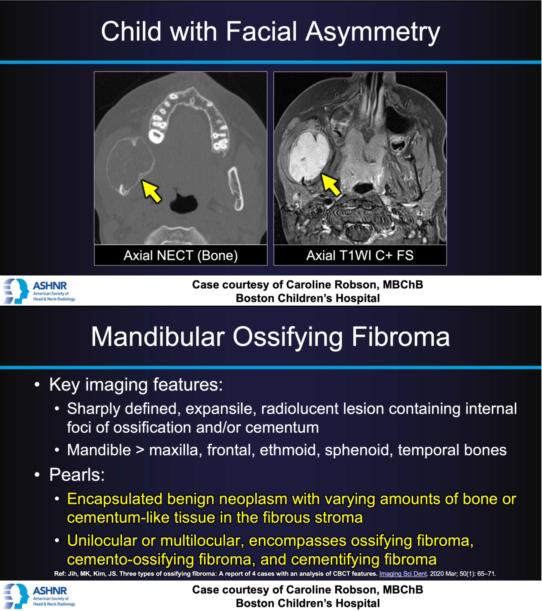 Ossifying Fibroma Maxilla