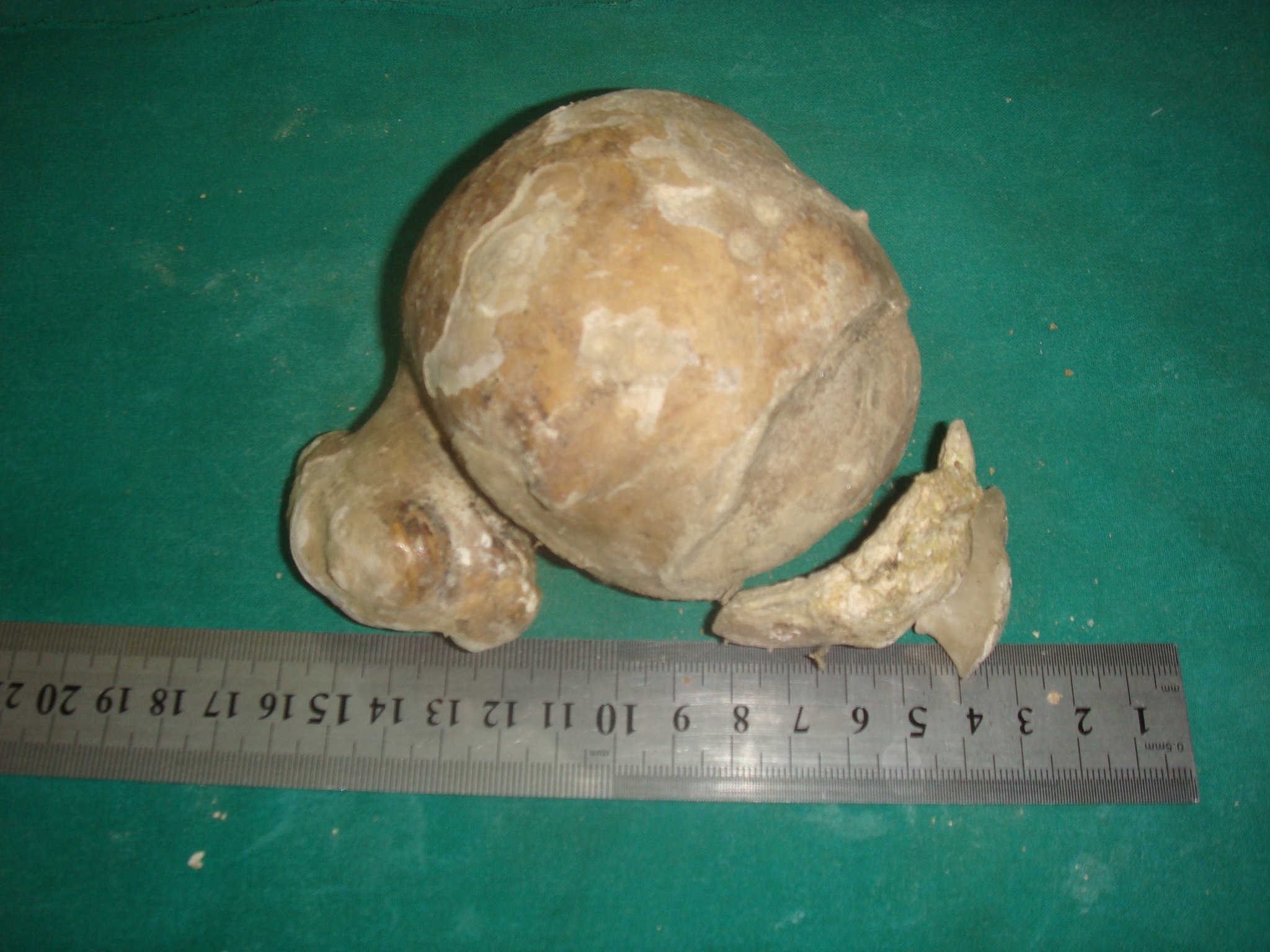 Worlds Largest Kidney Stone Passed Know When To Seek Help For Kidney