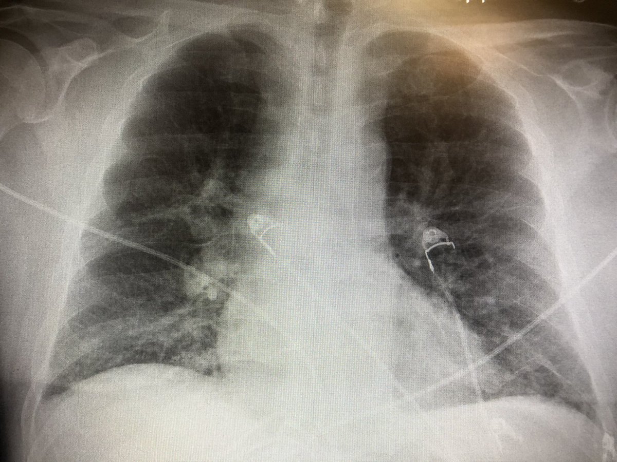 #lung #pocus > chest x-ray, a thread: 65 yo male with diabetes ...