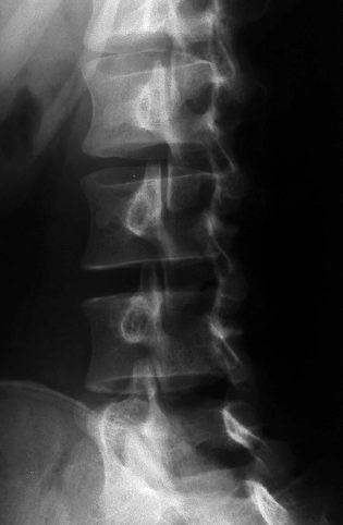 Spondylosis Scotty Dog