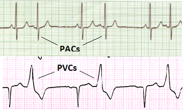 Ventricular Couplets
