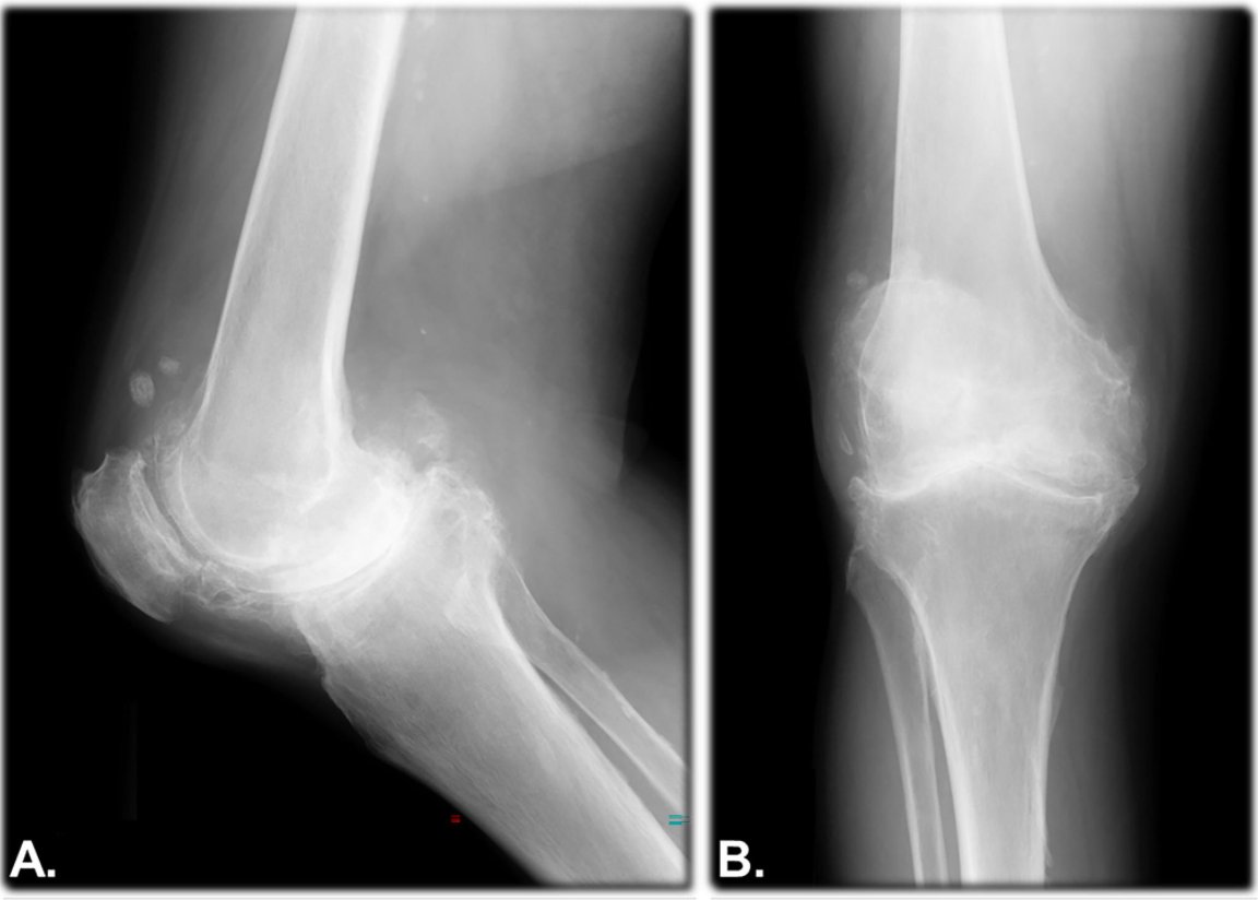 Septic Arthritis Xray