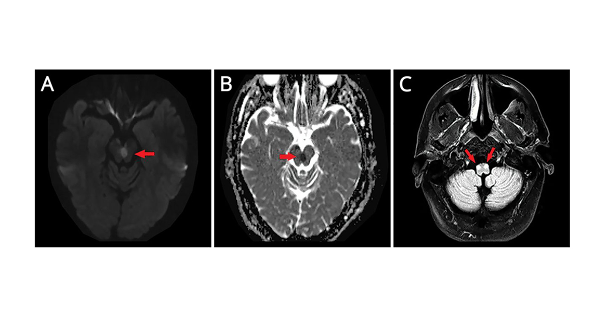 Paramedian Midbrain Syndrome