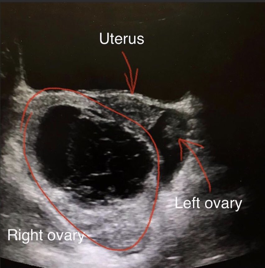 Enlarged Ovary Ultrasound