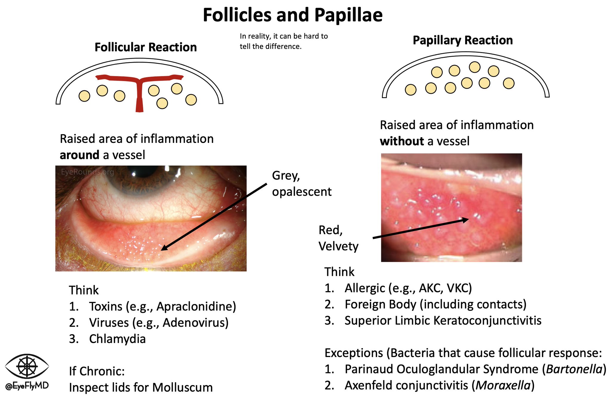 Conjunctival Follicles