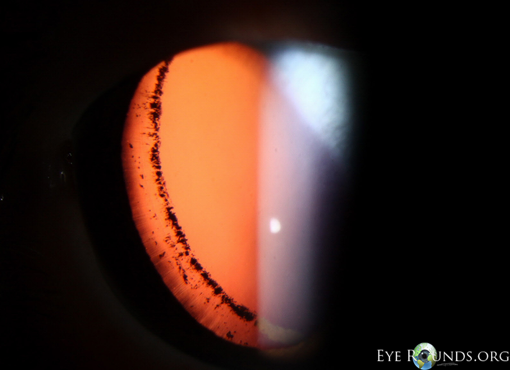 Pigment Dispersion Syndrome
