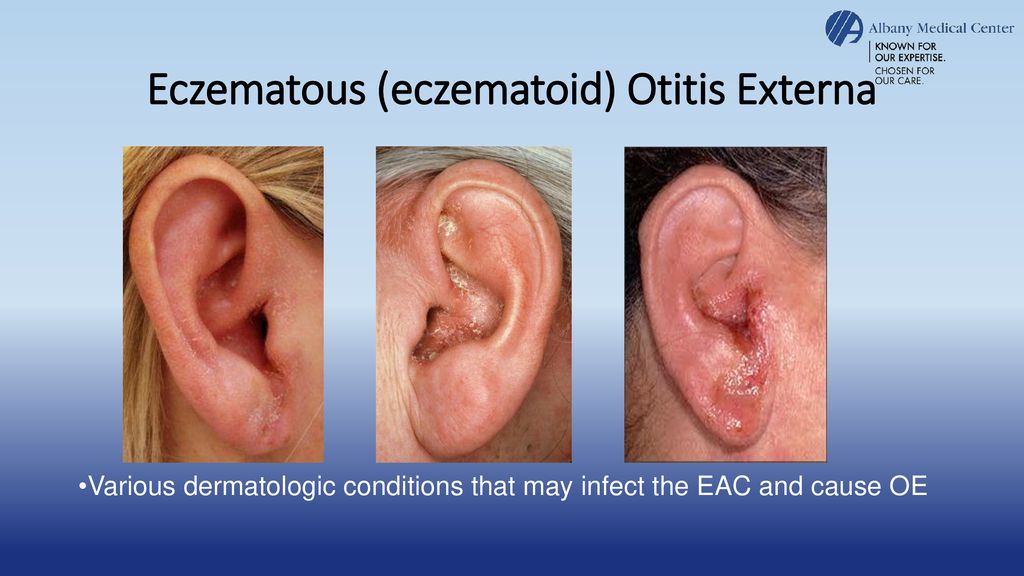 Diffuse Otitis Externa