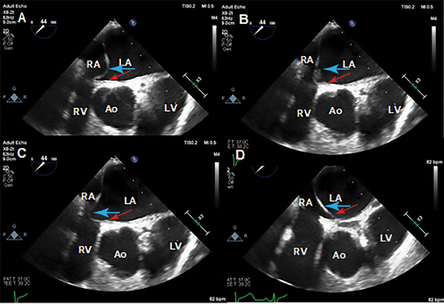 Antragsteller Anmerkung Voraussicht pfo tee Kalt werden Blendung Peitsche